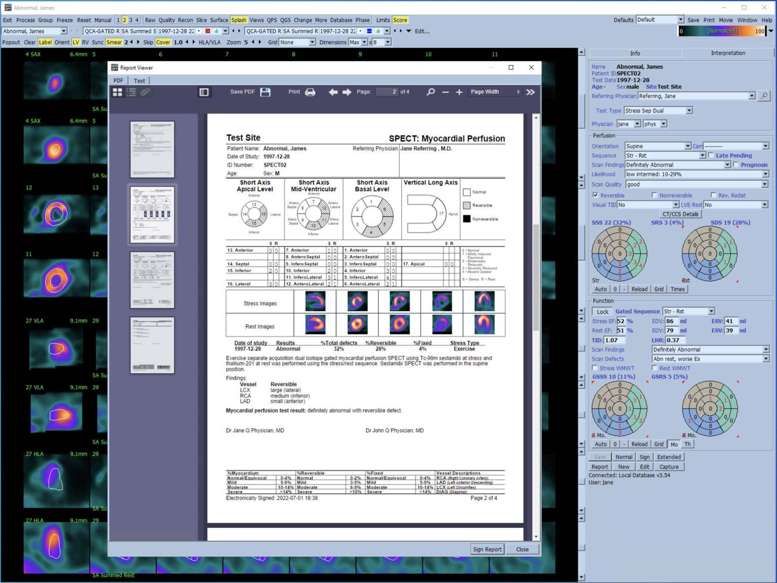 QGS+QPS - Quantitative Gated+Perfusion SPECT - QUAD Cedars-Sinai