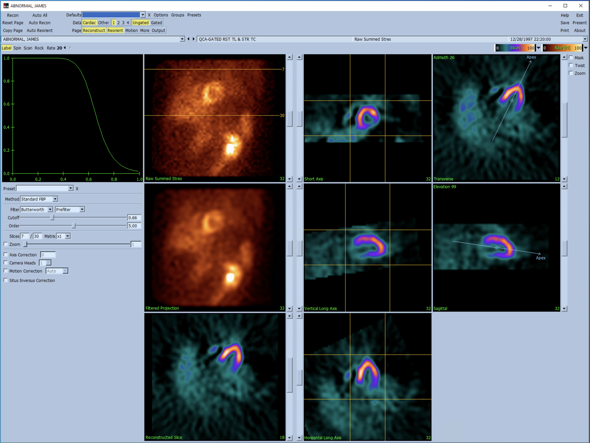 AutoRecon - Automated SPECT Reconstruction - QUAD Cedars-Sinai