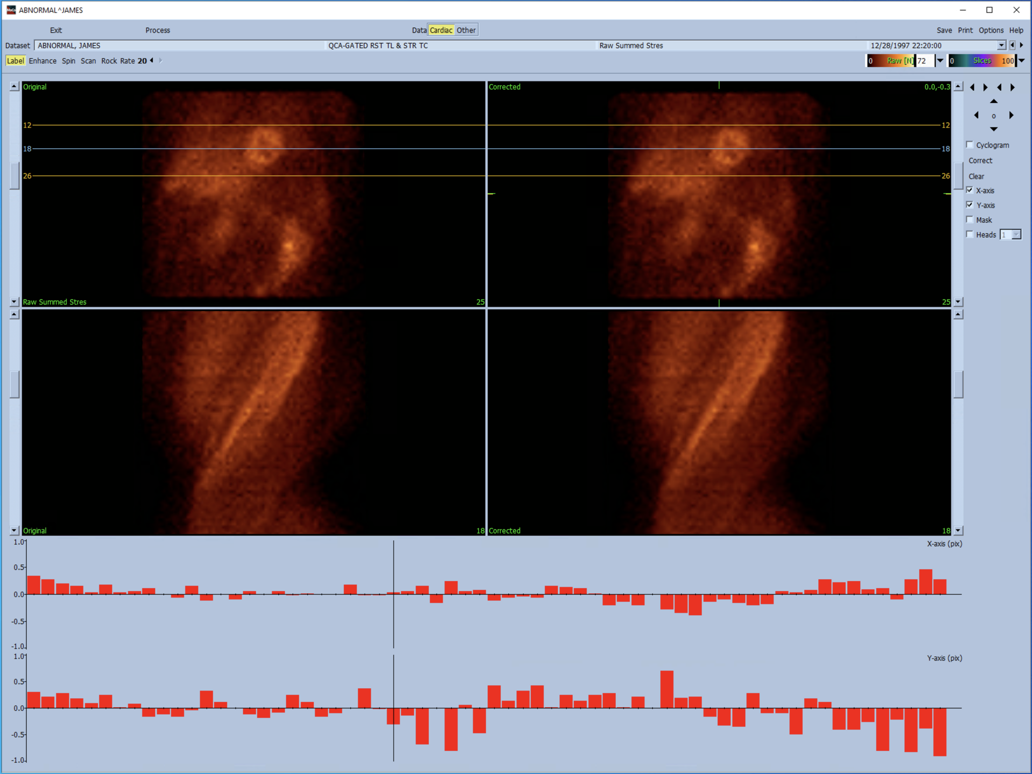MoCo - SPECT Motion Correction - QUAD Cedars-Sinai